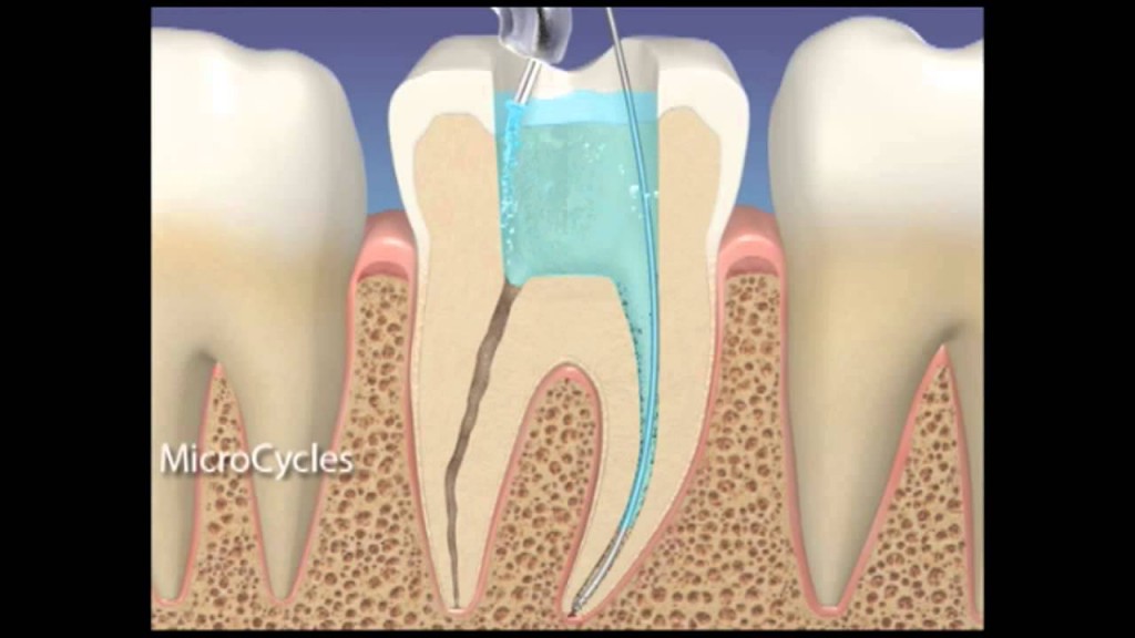 Vaš stomatolog : Lečenje kanala korena zuba-“vađenje živca” - Pokazivač